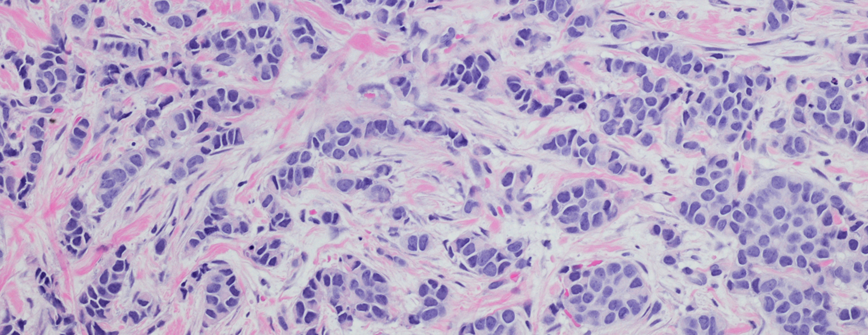 Basic Facts About Breast Health: Breast Cancer Staging | UCSF Health