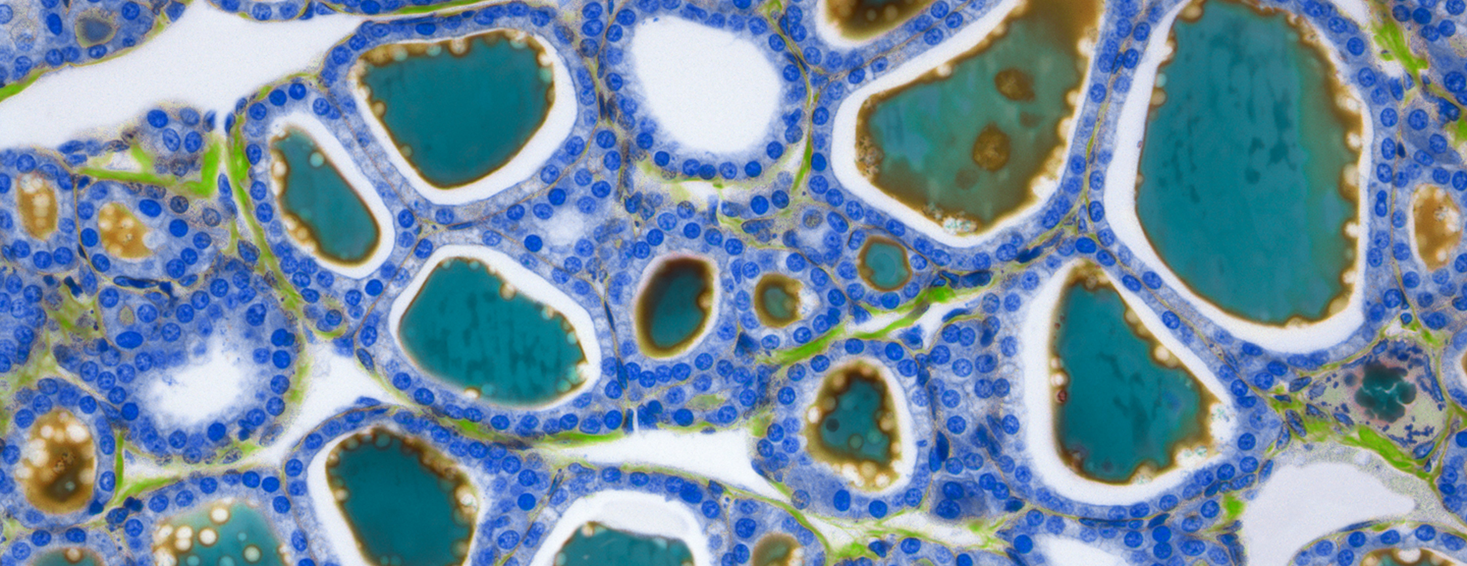 Antithyroglobulin antibody test