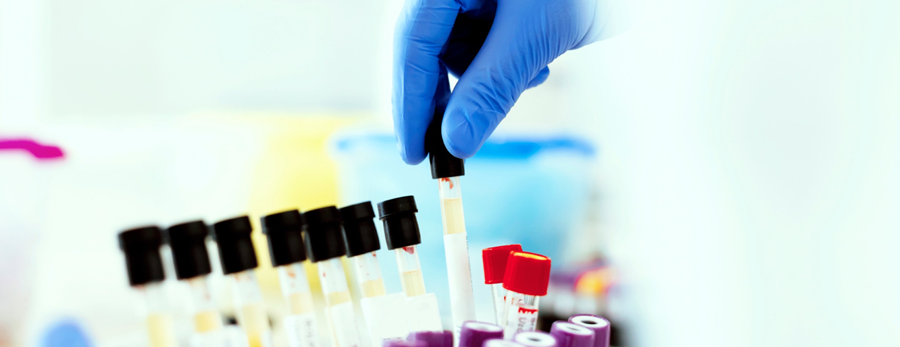 Cytology exam of urine