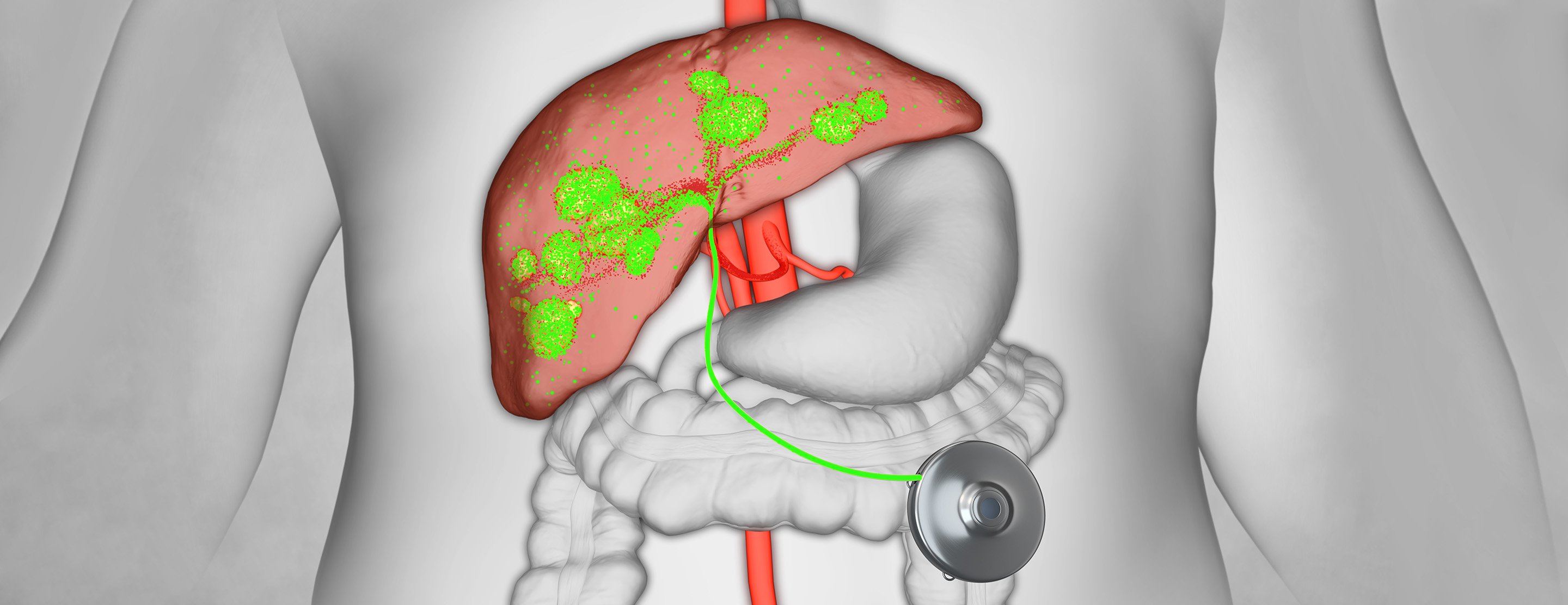 Hepatic Artery Infusion Pump | Conditions & Treatments | UCSF Health