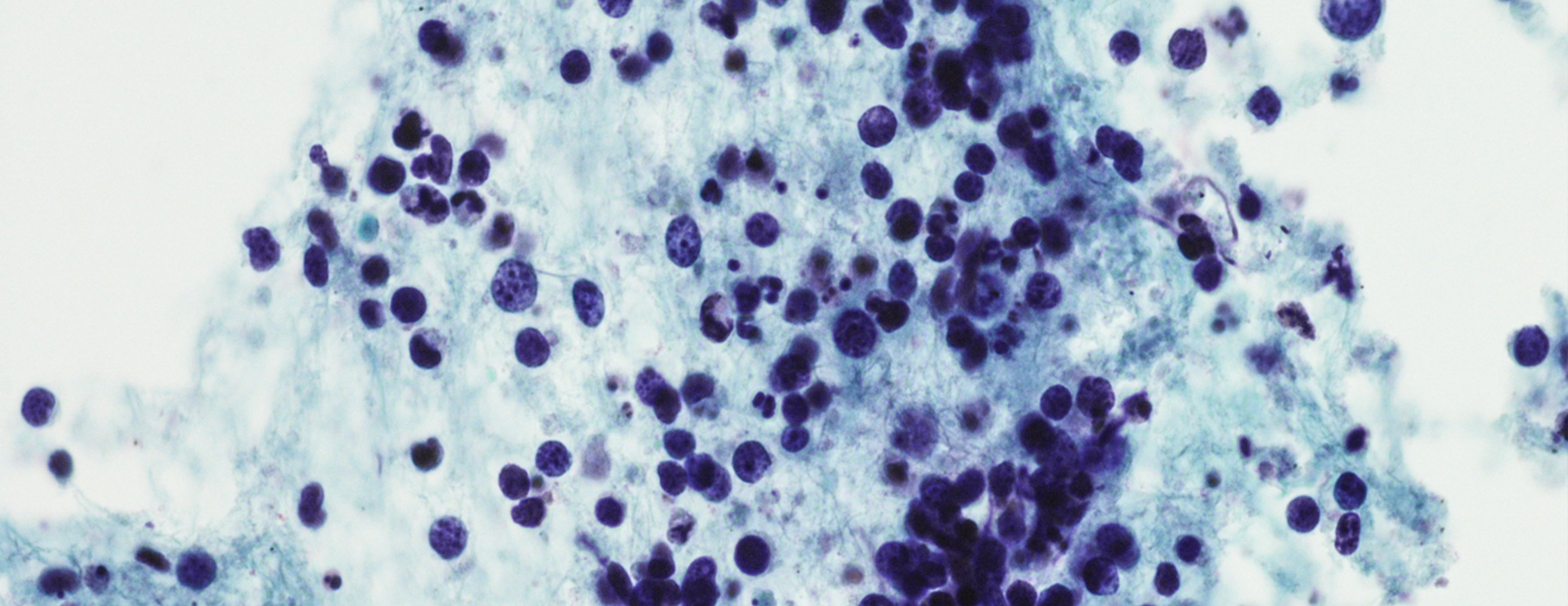 Intensity Modulated Radiation Therapy | Conditions & Treatments | UCSF ...