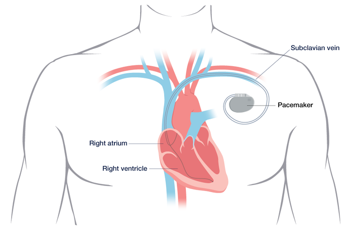 Pacemaker | Conditions & Treatments | UCSF Health Pacemaker | Conditions & Treatments | UCSF Health