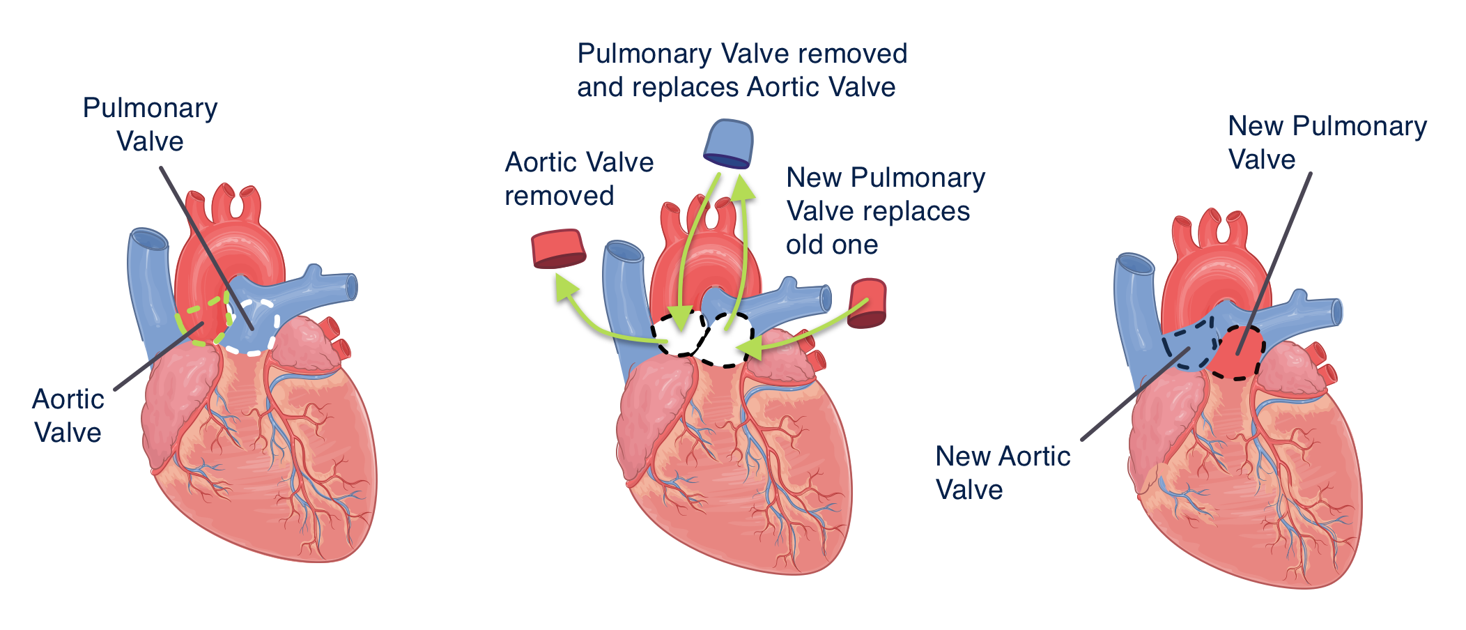 Ross Procedure Conditions And Treatments Ucsf Health